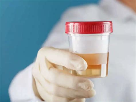 Общий анализ мочи как расшифровать результаты