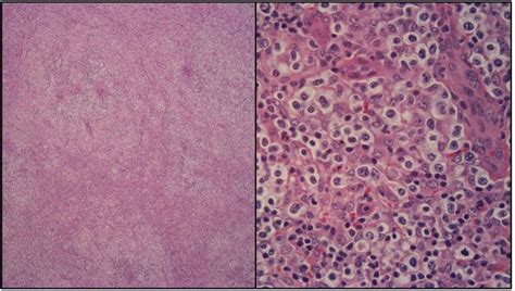 What Is Angioimmunoblastic T Cell Lymphoma Pathosomes
