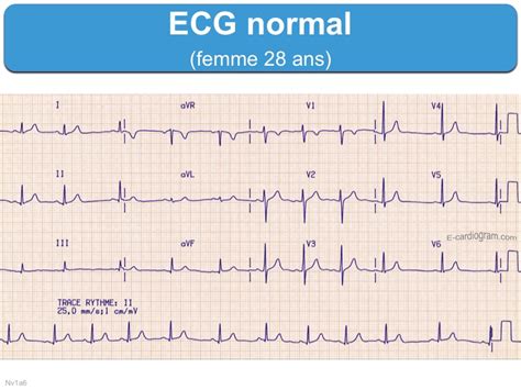Ecg Normal E Cardiogram