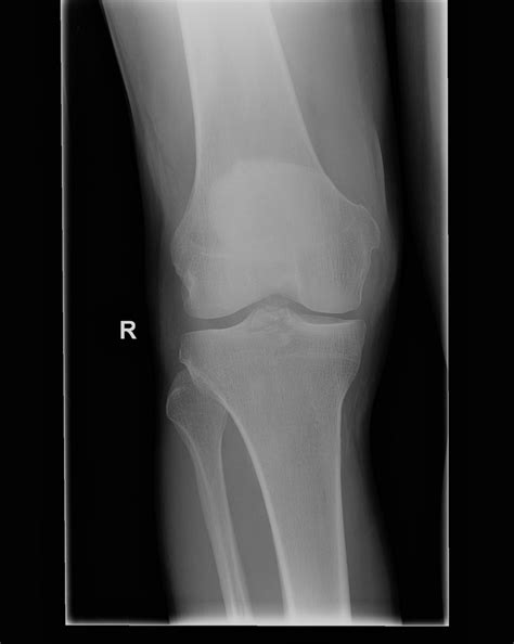 Radiopaedia Case Tibial Plateau Anterior Intercondylar Fracture Id