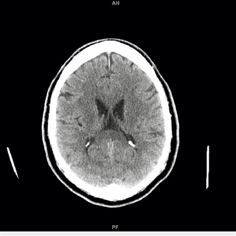 CT Scan Of The Head Showing Normal Architecture And No Ischemic Areas Download Scientific Diagram