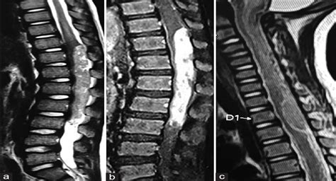 Primary Spinal Intradural Ewings Sarcoma Hemorrhagic Prese Neurology India
