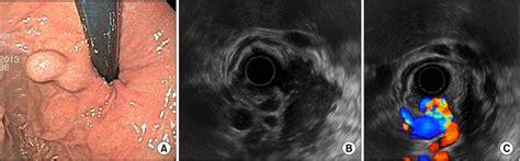 A Endosocpic Finding Of Protruded Lobular Subepithelial Lesion At