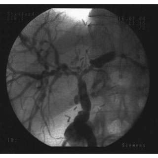 Endoscopic Cholangiogram Showing Ischemic Type Biliary Lesions Download Scientific Diagram