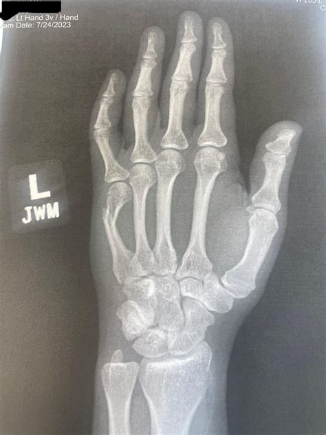 Metacarpal Fracture R Xrayporn