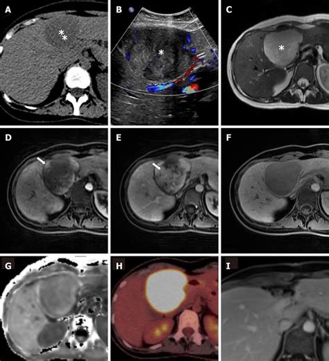 Imaging Features Within The Liver Lesion In Segment Iv A The Lesion Download Scientific
