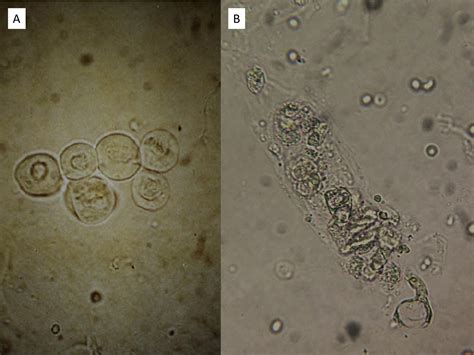 Urine Sediment Of The Month Pigmented Casts What Those