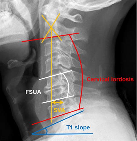 Frontiers The Fatty Infiltration Into Cervical Paraspinal Muscle As A Predictor Of