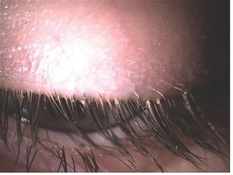 Demodex Infestation Diagnosis And Management Insight