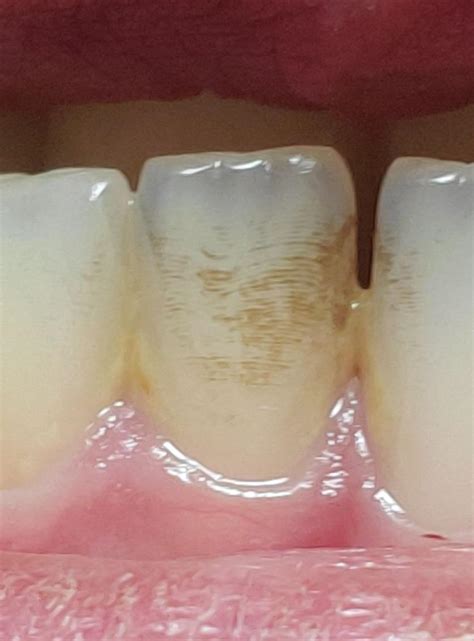 Why Does One Tooth Look Like This Is It Cause For Concern Rteethcare