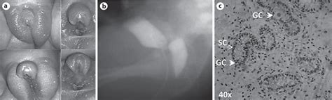 Figure 2 From Preserved Fertility In A Patient With A 46xy Disorder Of