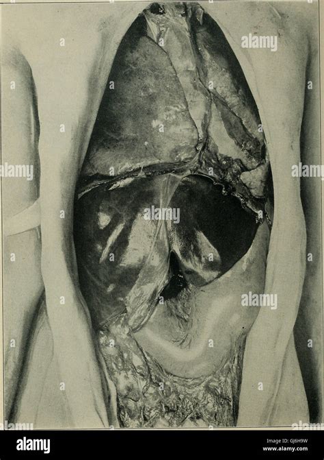 Postmortem Pathology Manual Technic Post Mortem Fotos Und