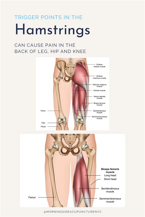 Acupuncture For Calf Trigger Points Artofit