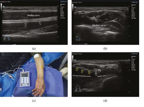 Figure 1 From Ultrasound Guided Median Nerve Electrical Stimulation To Promote Upper Limb