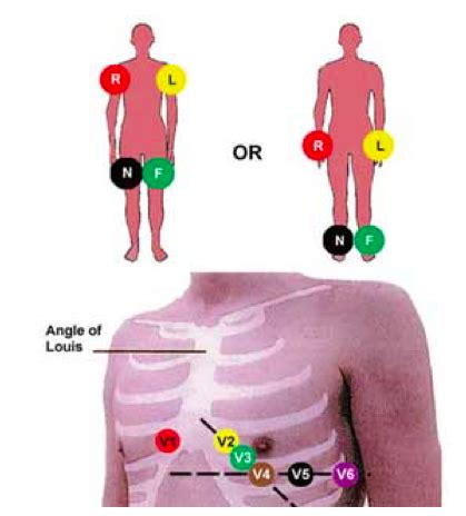 CPP ECG Recording And Interpretation Flashcards Quizlet