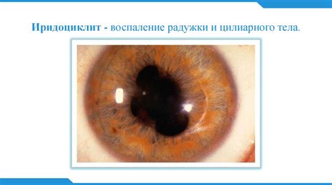 Заболевания сосудистого тракта хрусталика стекловидного тела роговицы и склеры презентация