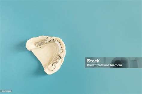 모형 금속 프레임 하부 부분 틀니 플레이트 온 다이 스톤 하부 턱의 석고 캐스트 금형 코발트 크롬 치과 플레이트 파란색 배경에 플랫 레이 모형 3d 인쇄 다리 공간 복사를