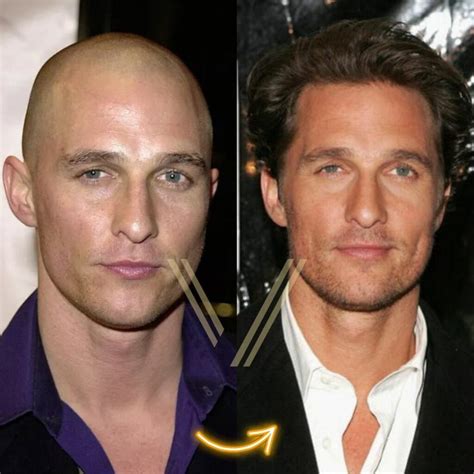 Matthew Mcconaugheys Hair Transplant The Hollywood Stars Secret To Rejuvenated Look