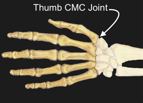 Thumb Cmc Basilar Joint Anatomy Anatomic Structures At Risk