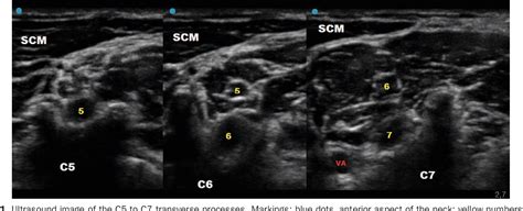 Figure 1 From Selective Low Volume Nerve Block For The Open Surgical