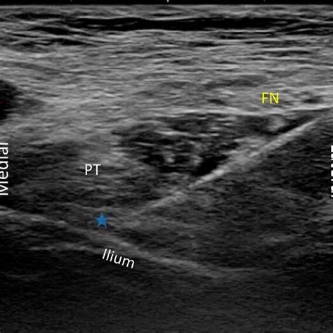 Ultrasound Guided Pericapsular Nerve Group Block Fa Femoral Artery Download Scientific