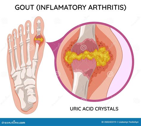 Gout Vector Illustration CartoonDealer Com 47778752