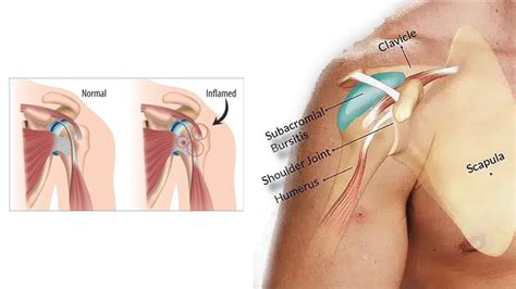 Subacromial Shoulder Bursitis Anf Academy