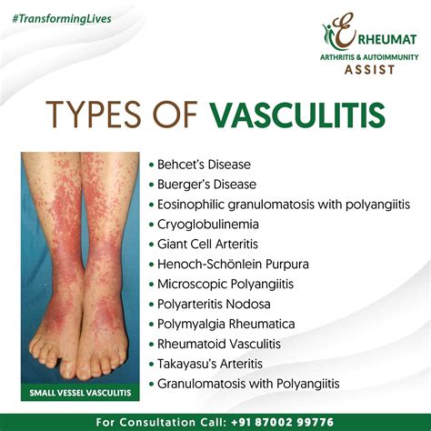Dr Sonal Mehra Rheumatologist Vasculitis Is An Inflammation Of The