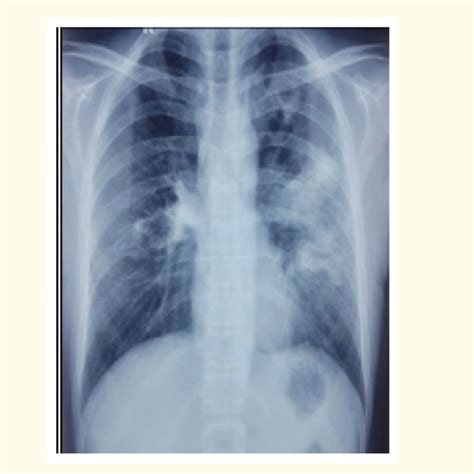 Chest Radiograph Showing Left Mid Zone Opacity Along With Right Hilar Download Scientific