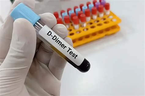 DÍmero D Pro Médicos