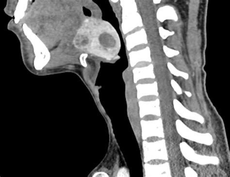 Multinodular Goiter Pacs