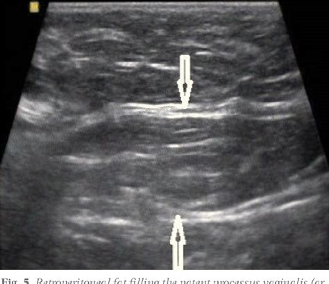 Indirect Inguinal Hernia Ultrasound