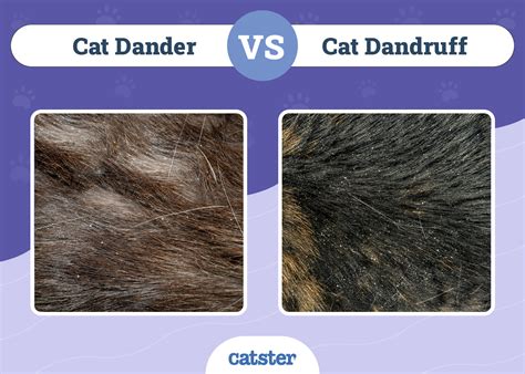 Lice Vs Dandruff Side By Side