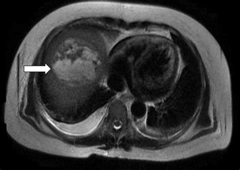 Abdominal Magnetic Resonance Imaging Revealed A Large Hepatic Abscess