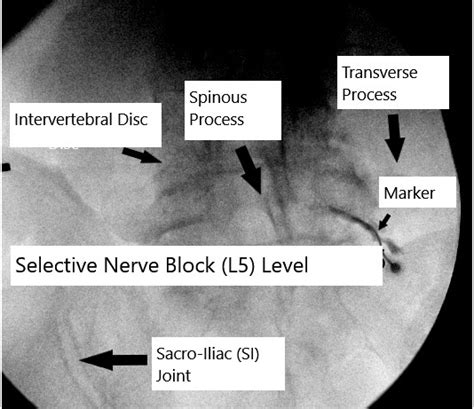 Selective Nerve Root Block Complete Orthopedics Multiple Ny Locations