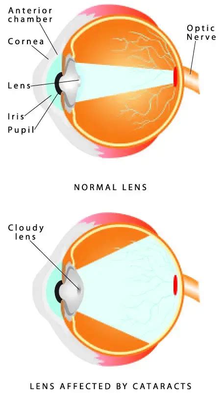 Cataract Eye Specialists Of Delaware