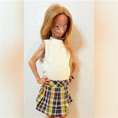 Adalia Rose nie żyje Miała 15 lat Chorowała na rzadką chorobę genetyczną