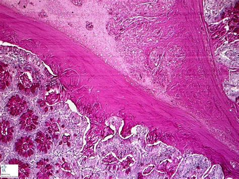 Viscous Digestive Mucus Human Pathology
