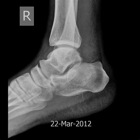 Calcaneal