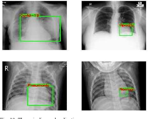 Figure 10 From Deep Learning Based Thoracic Disease Detection And Localization In Chest
