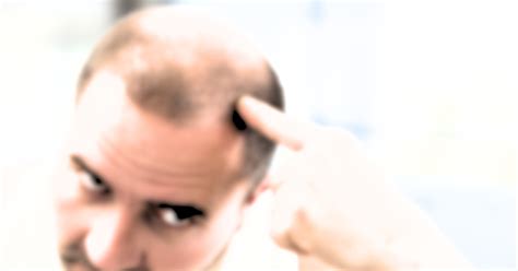 Scalp Lesion Removal Treatments Hairline Mole Removal Scalp Lesion Removal Treatments Hairline Mole Removal