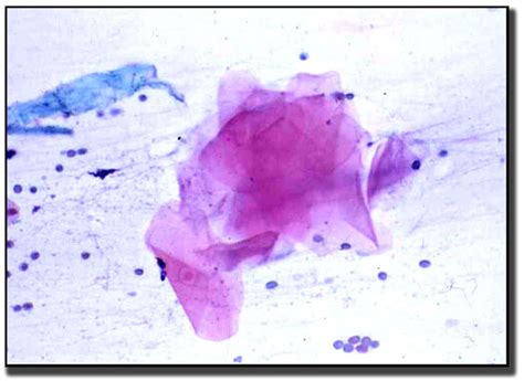 Cytol Anucleate Squamous Cells Bdr Wisconsin State Laboratory Of Hygiene
