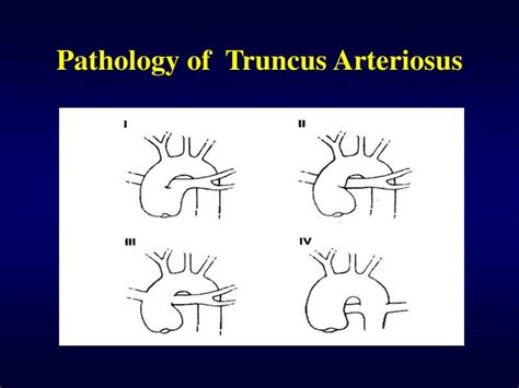 Ppt Truncus Arteriosus Powerpoint Presentation Id 597141