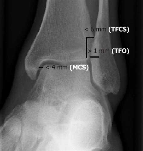 Normal Values Of Tibiofibular Clear Space Tibiofibular Overlap And Download Scientific Diagram