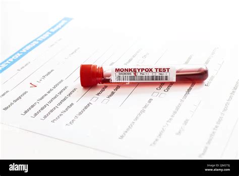 Tube With Positive Monkeypox Test Blood On Analysis Form Close Up With