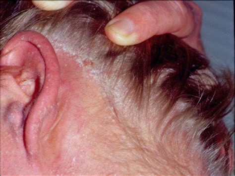 Crusted Scabies Scalp