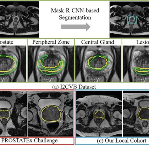 Samples Of Automated Prostate Segmentation With Mask R Cnn A Results Download Scientific