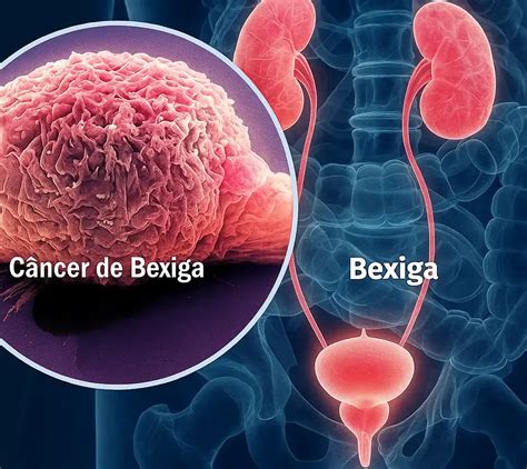 Câncer De Bexiga Guia Completo De Sintomas Diagnóstico E Tratamento