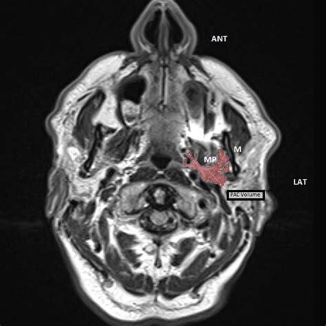 Mri Axial Section Showing Semi Automatic Segmentation The Software Download Scientific Diagram