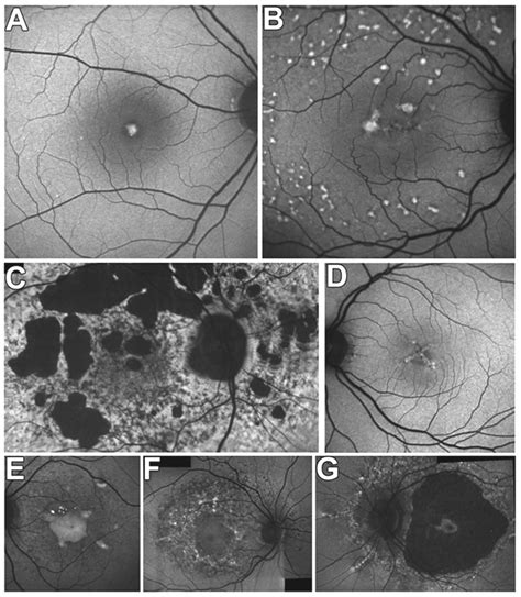 18 Faf In Pattern Dystrophies A Adult Onset Foveomacular Vitelliform Download Scientific